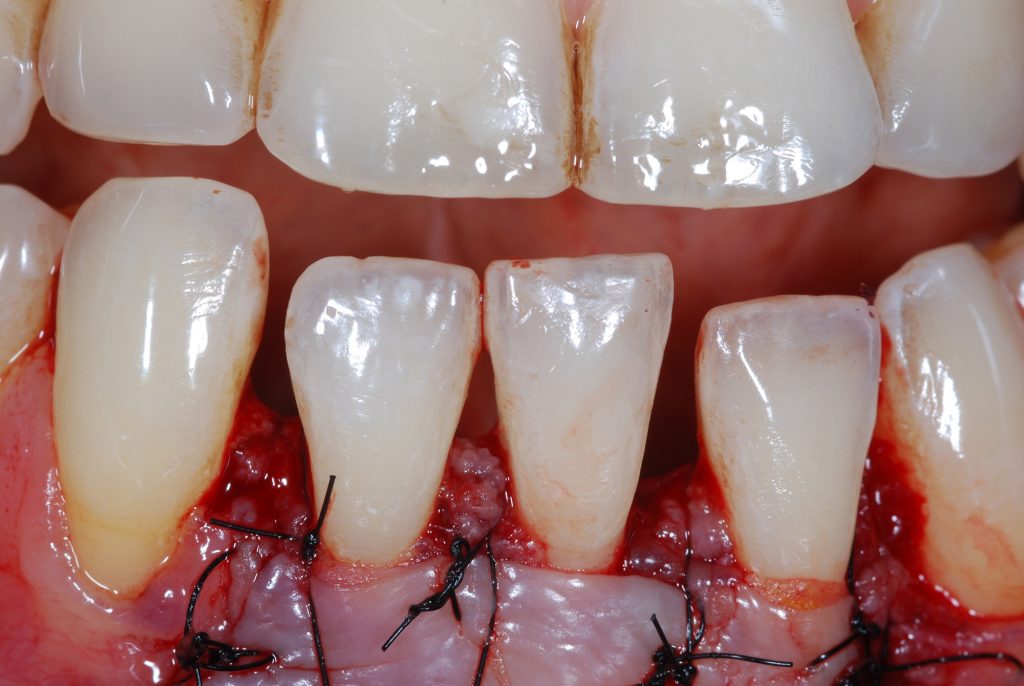 Gingival grafts clinical case - Cabinet Reine Blanche